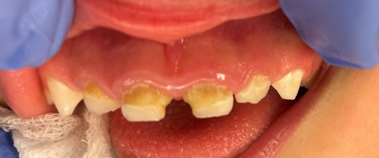 Santa Maria Pediatric Dental Crowns | White Anterior Crowns