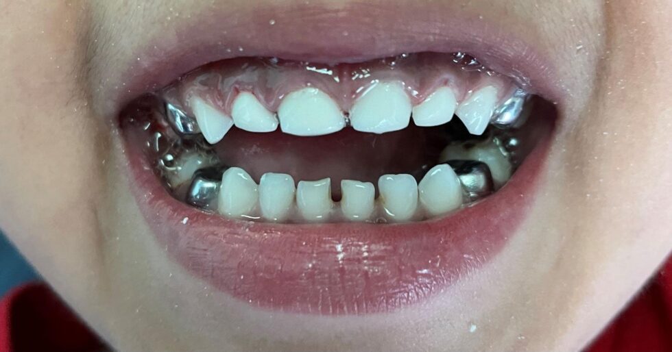 Santa Maria Pediatric Dental Crowns | White Anterior Crowns