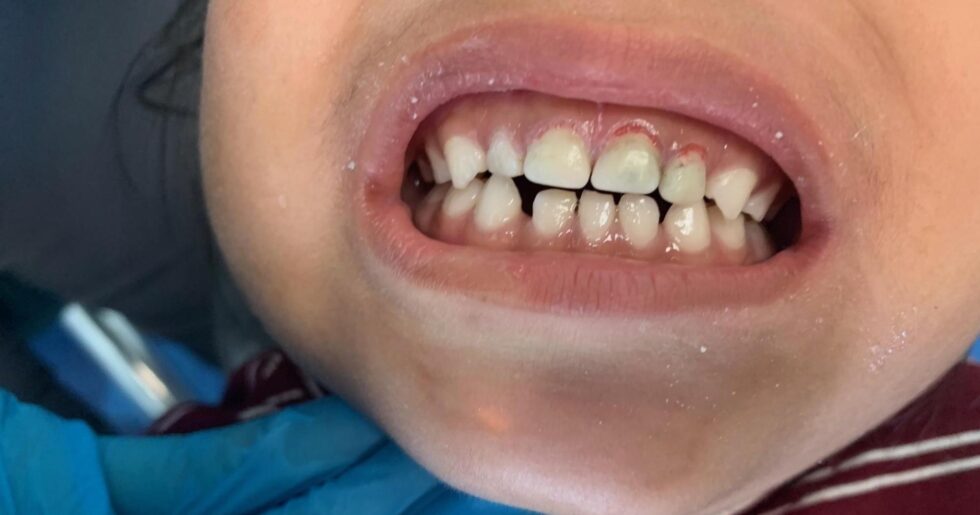 Santa Maria Pediatric Dental Crowns | White Anterior Crowns